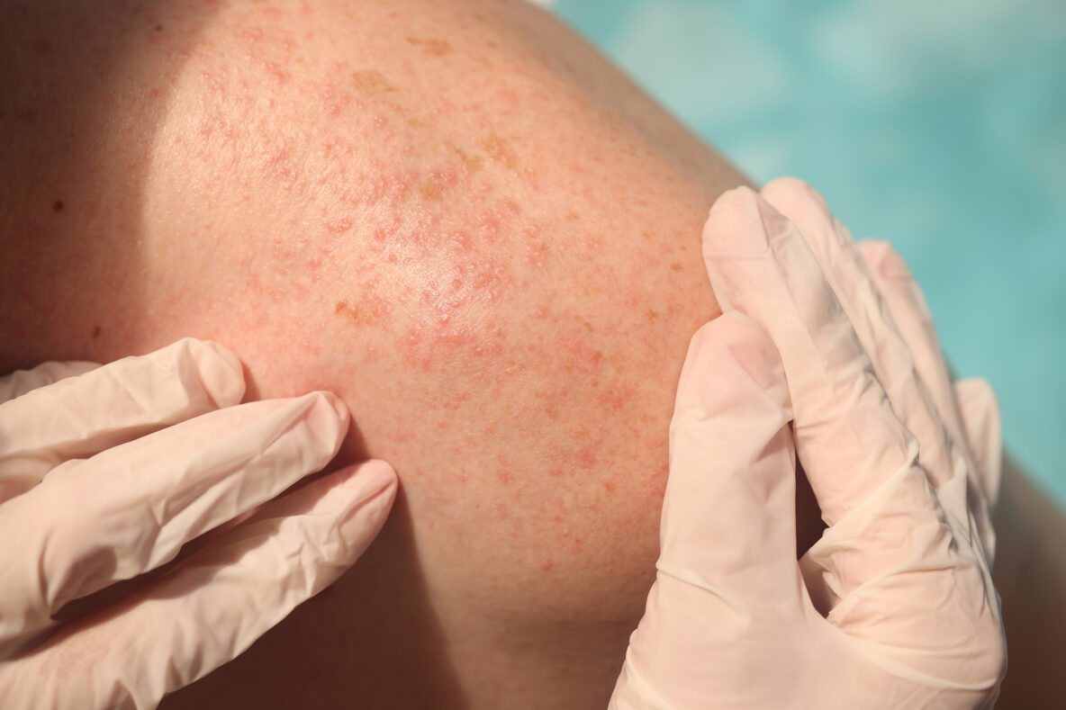 Thyroid Skin Rash Pictures What To Look For
