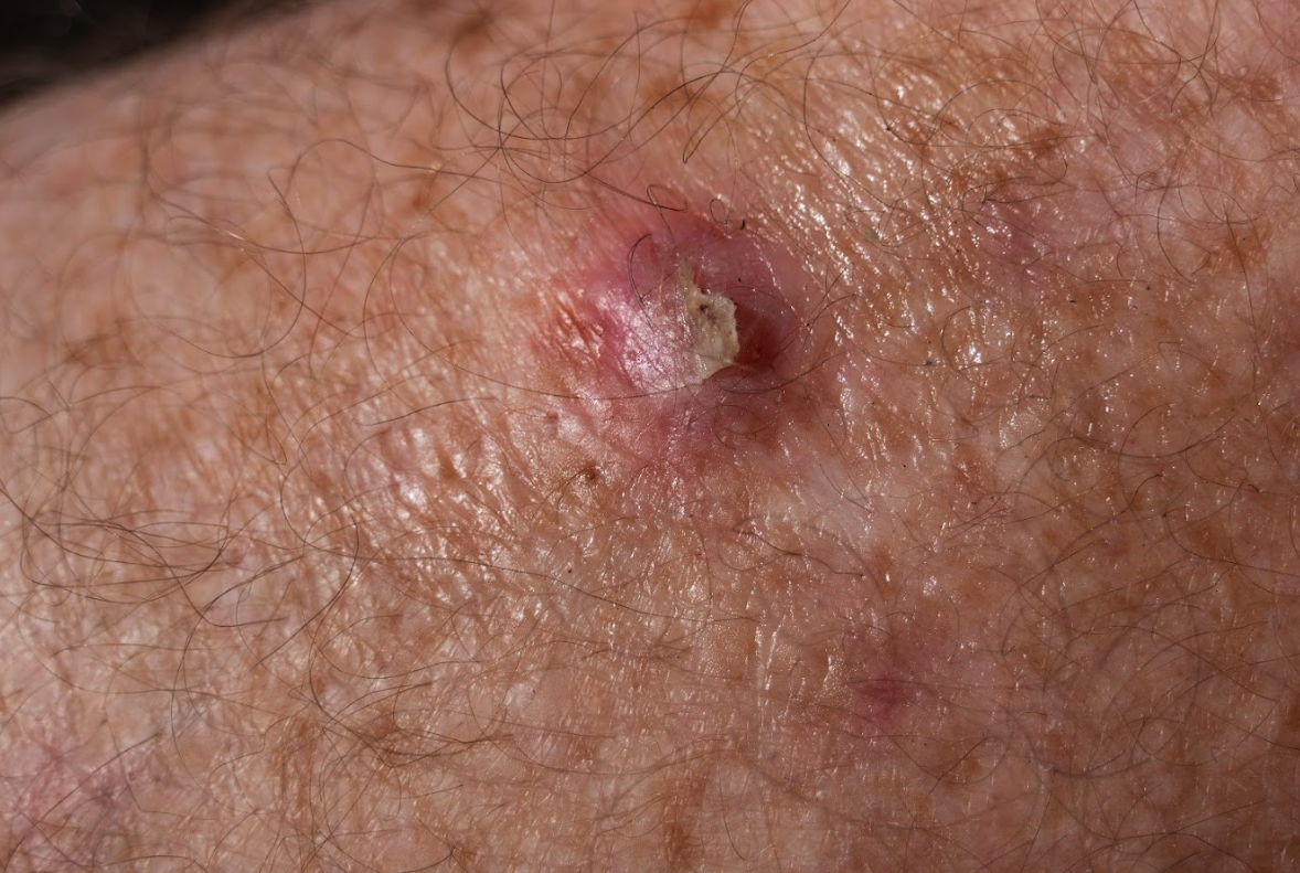 Mastering the Self Skin Exam: Your Guide to Early Detection | Treasure ...