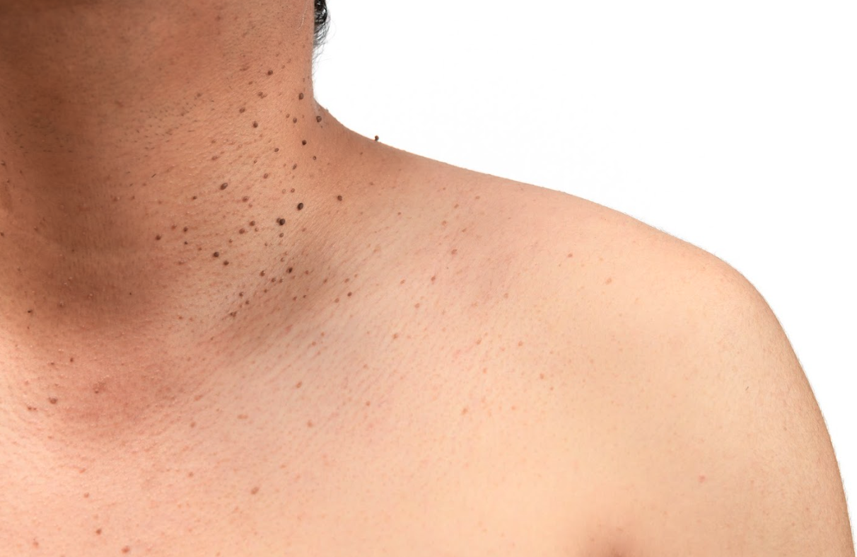 Skin Tags | Treasure Valley Dermatology | Dr. Dustin Portela