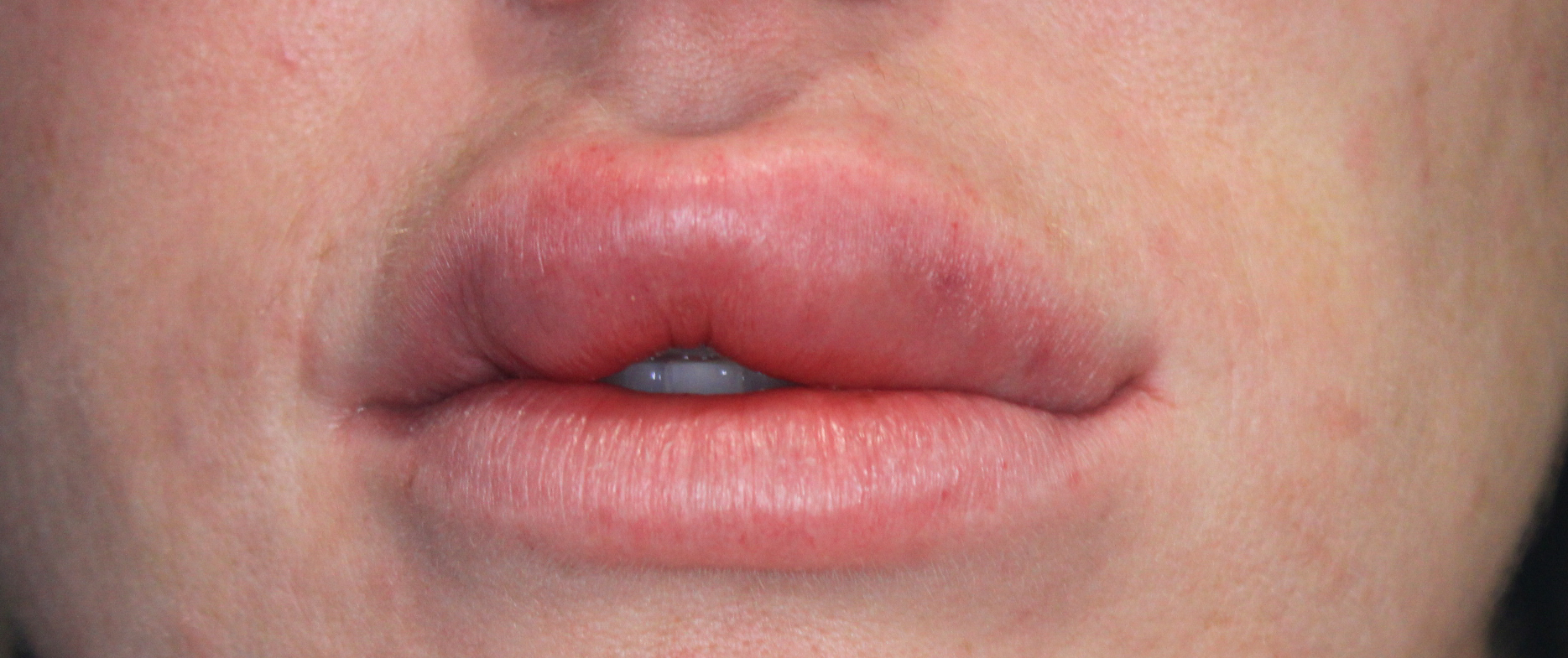 Case Study: Dealing with a Suspected Vascular Occlusion | Arlo Medical