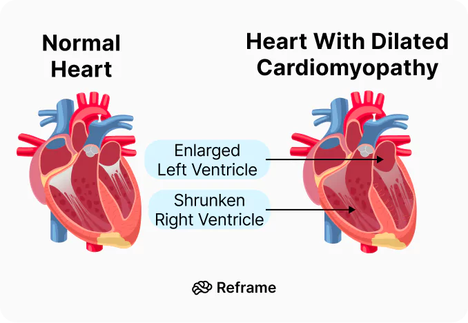 What Is Alcohol-Induced Cardiomyopathy? | Reframe App