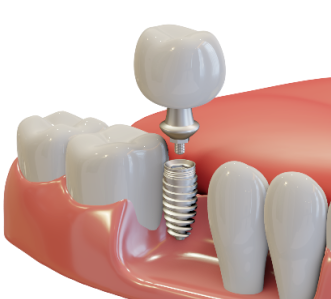 Maricopa County Dental Implants | New Horizon Institute