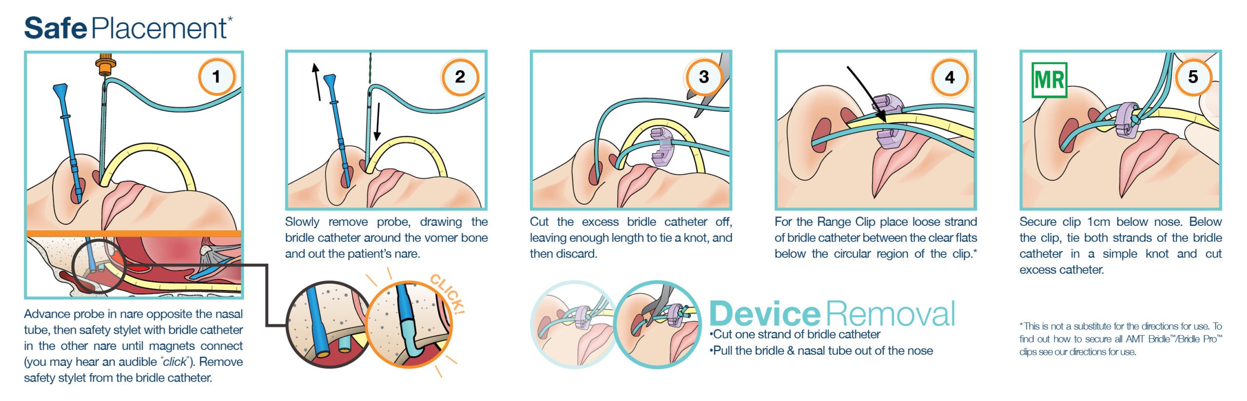 Bridle™️ | Enteral Feeding