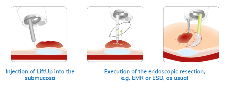 Submucosal lifting agents | Gastroenterology