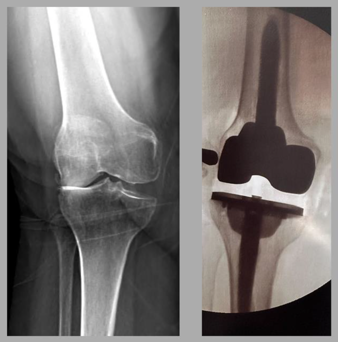 Total Joint Orthopedics Receives FDA Clearance on the Klassic® Knee ...