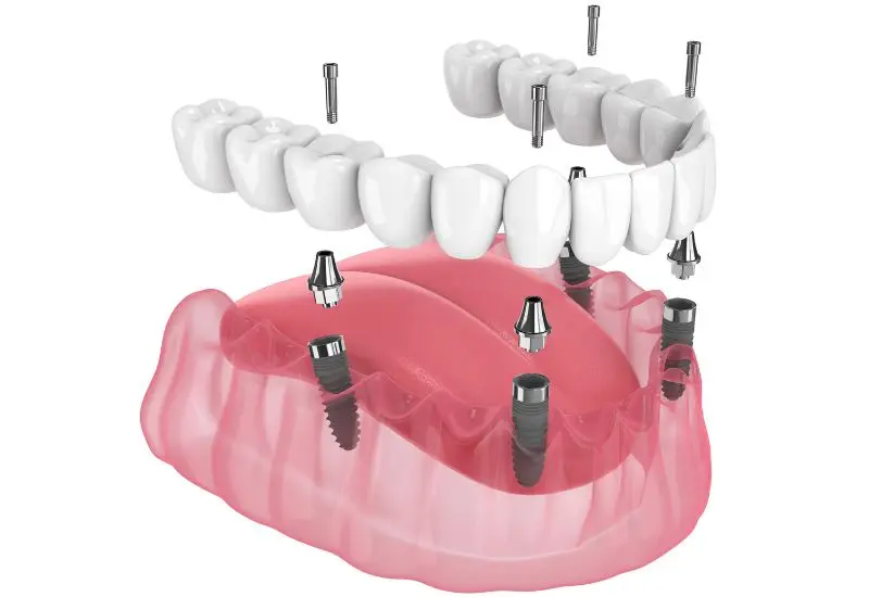 All on 4 success rate and the factors that impact it