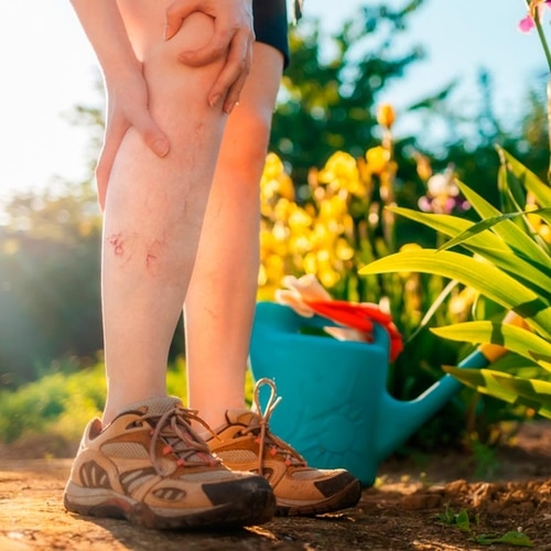 What Are Varicose Veins Uk Vein Clinic