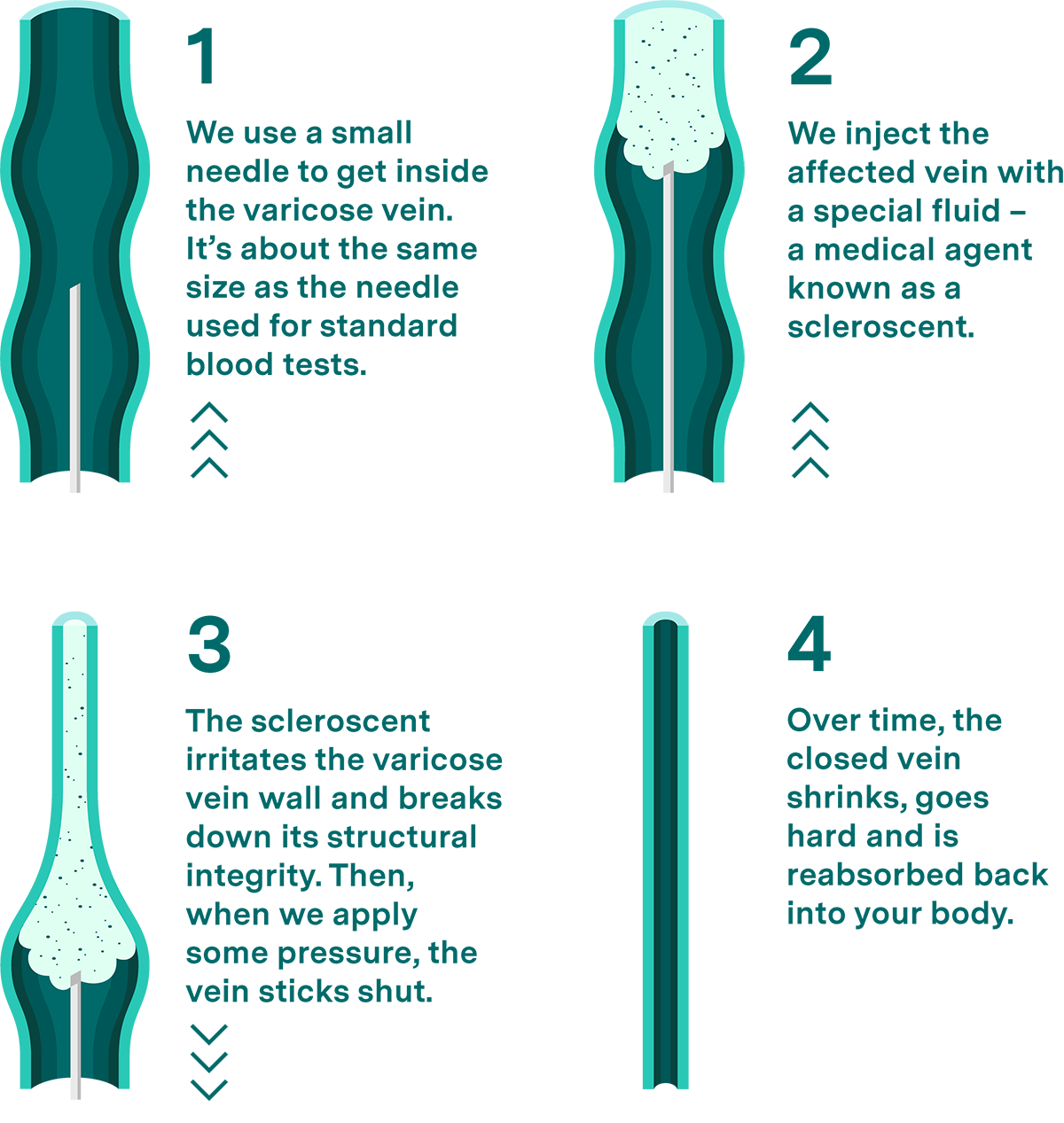 Foam Sclerotherapy for Varicose Veins | Sclerotherapy Treatment