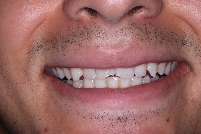 The Different Types of Chipped Tooth Repair Options