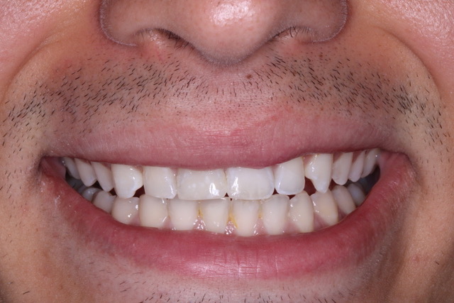 Chipped Front Teeth | Patient Before and After