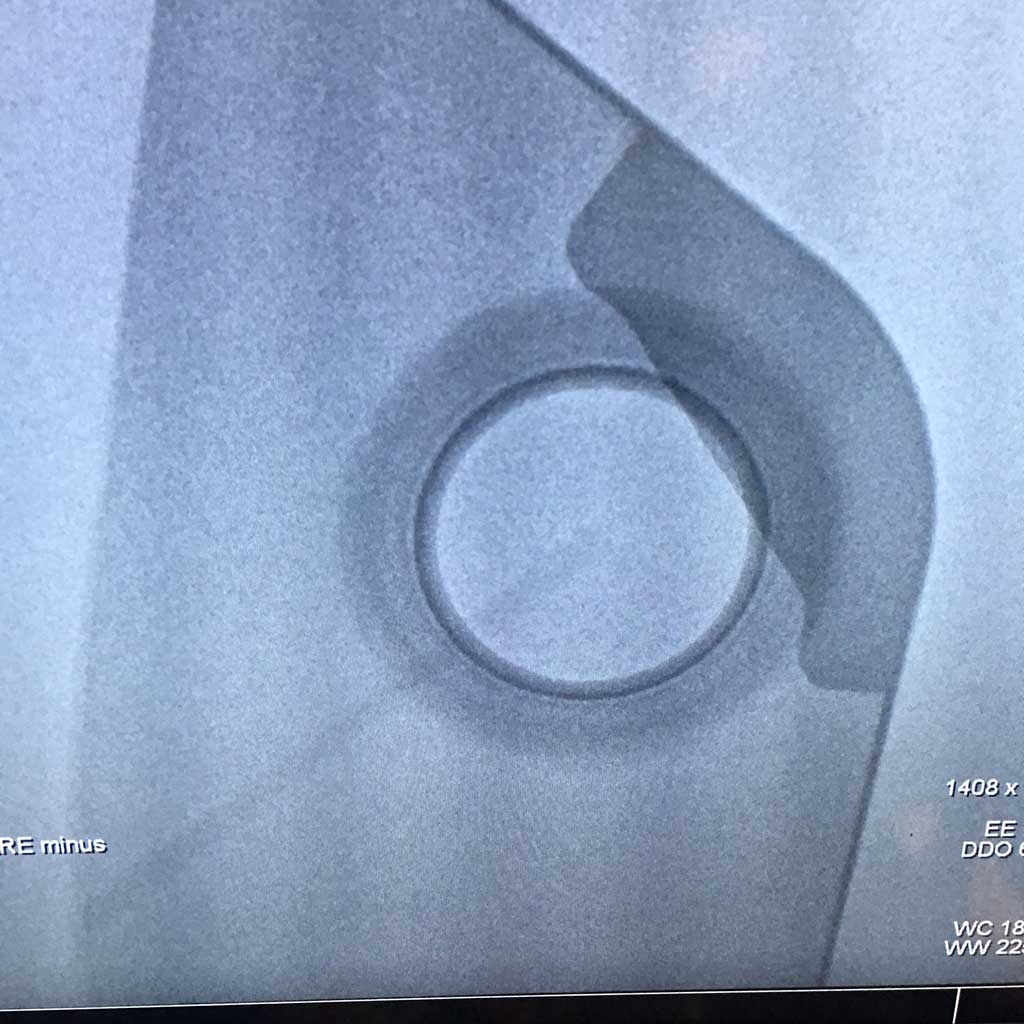Retrograde IR Platform - Adept Medical