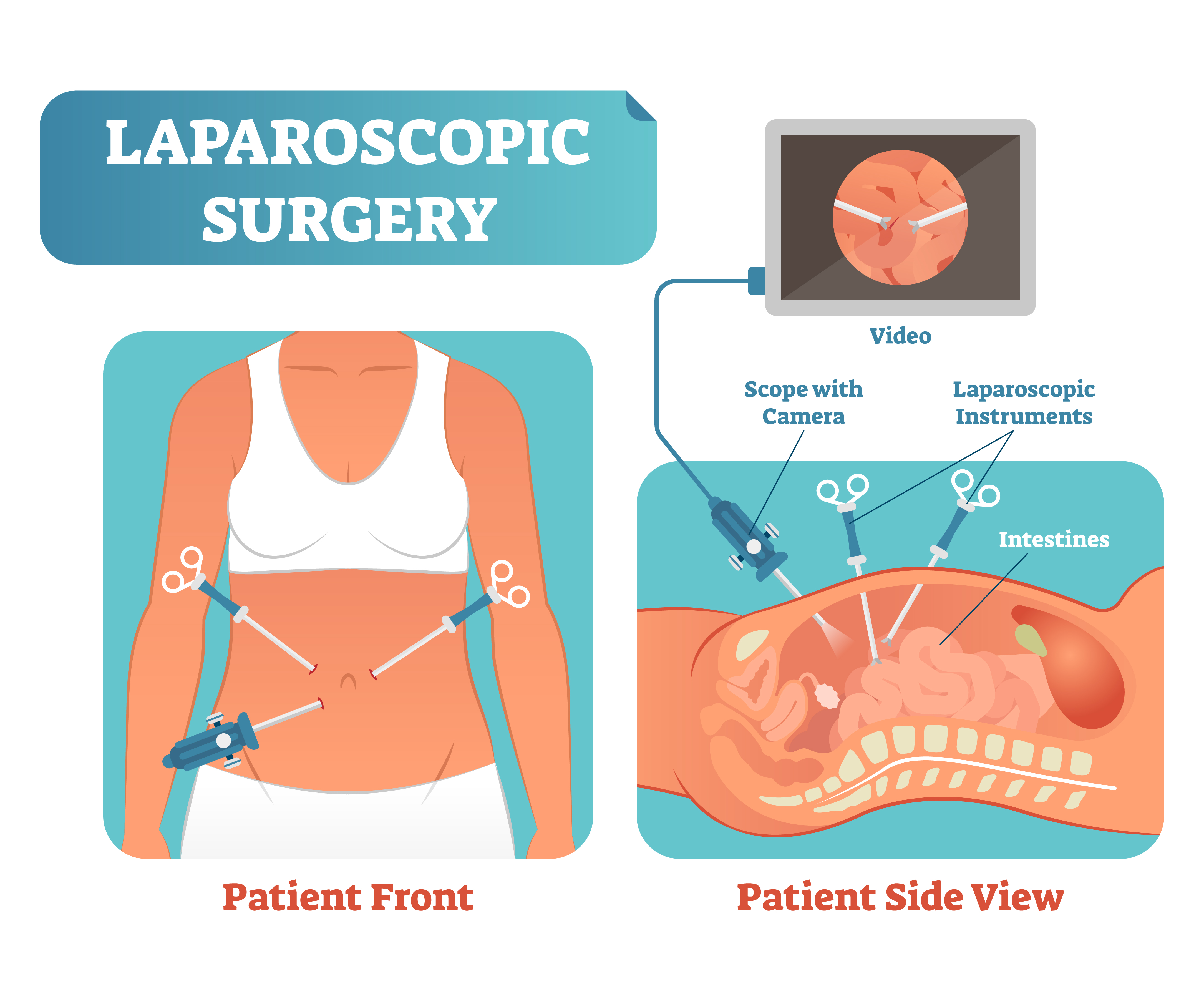 Laparoscopic Scope