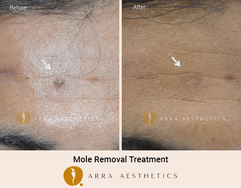 Remove Skin Growths Permanently With The RecoSMA Laser