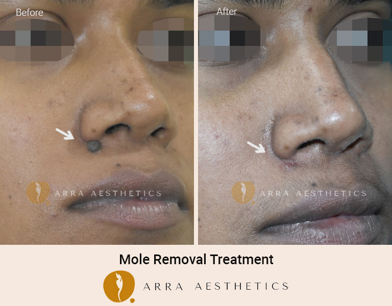 Remove Skin Growths Permanently With The RecoSMA Laser