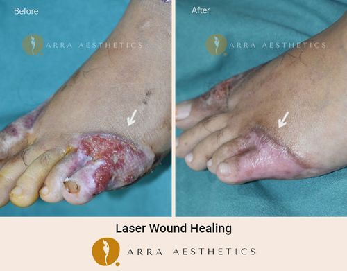 Treat Non-Healing Wounds Using The RecoSMA Laser In Pune