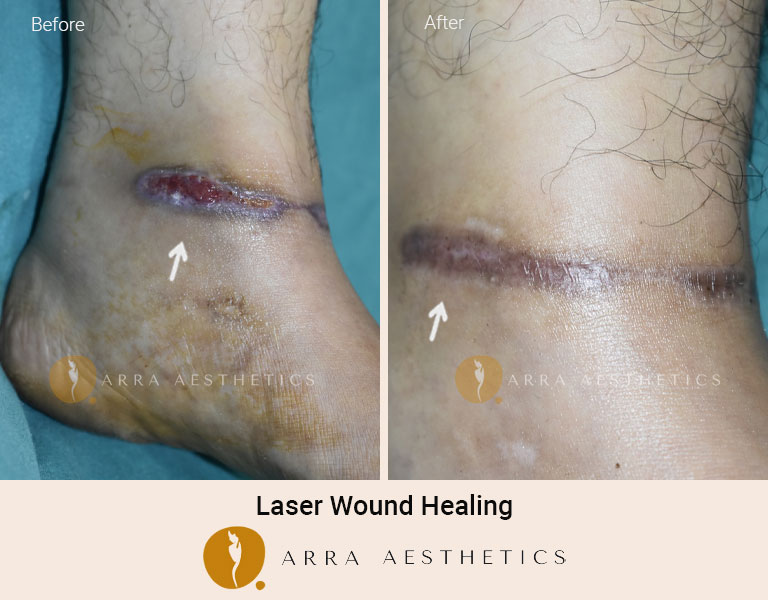 Treat Non-Healing Wounds Using The RecoSMA Laser In Pune