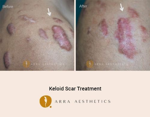 Treat Keloid & Hypertrophic Scar with Laser Treatment | Pune