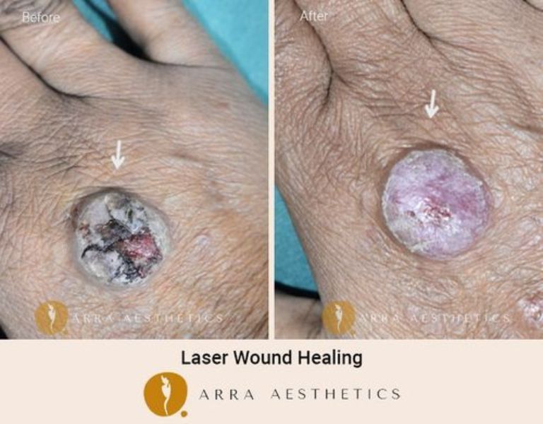 Treat Non-Healing Wounds Using The RecoSMA Laser In Pune