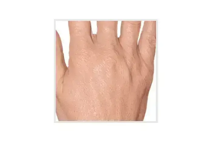 HYAcorp | Face and Body Contouring Fillers