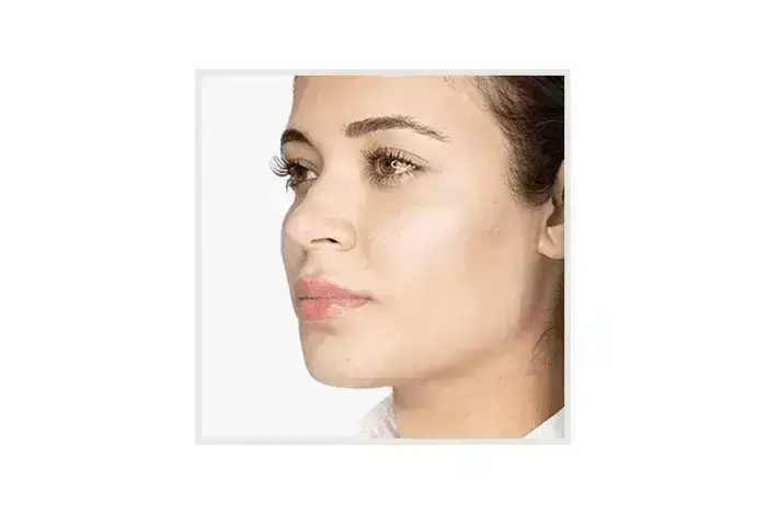 HYAcorp | Face and Body Contouring Fillers
