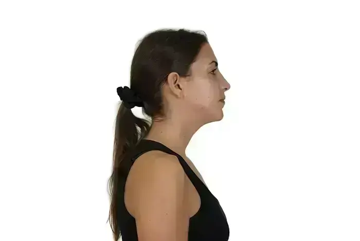 HYAcorp | Face and Body Contouring Fillers