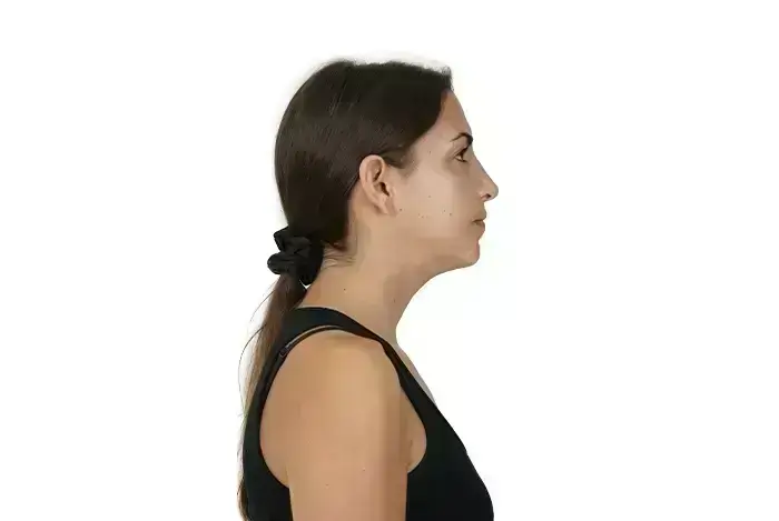 HYAcorp | Face and Body Contouring Fillers