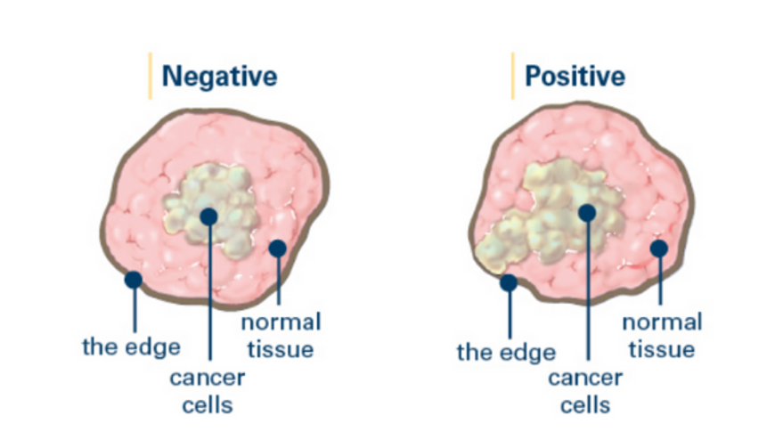 Guide to Understanding Surgical Margins | KUBTEC