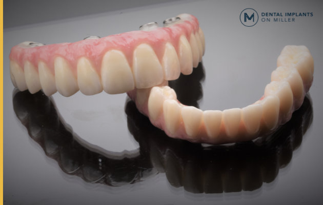 The All on 4 Procedure: Everything you need to know Step-by-Step