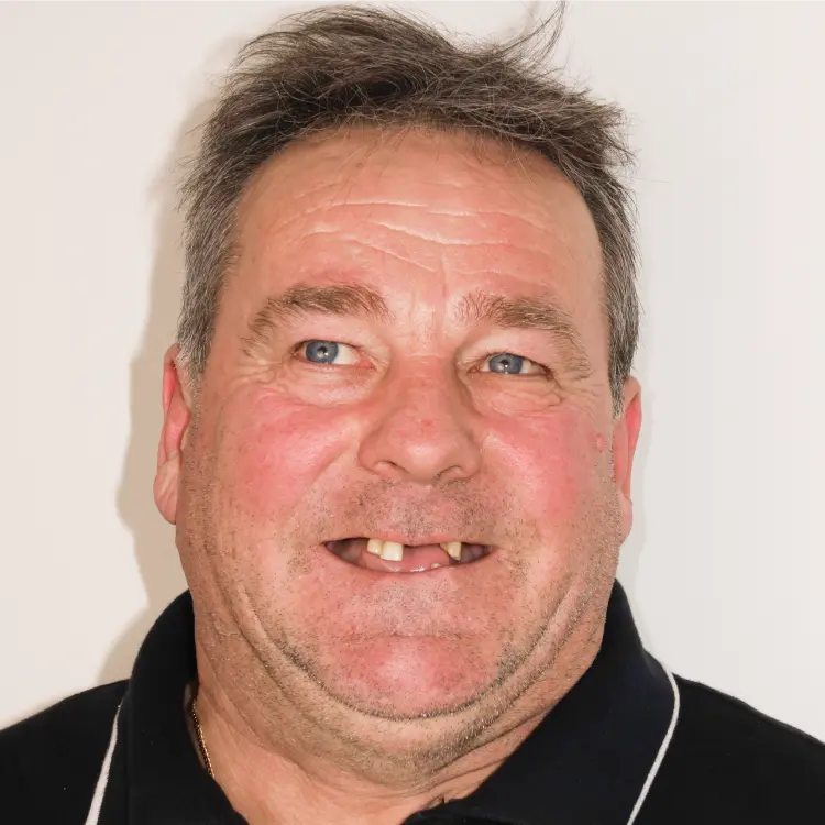 All on 4 dental implants Sydney, Book Your Free Consult