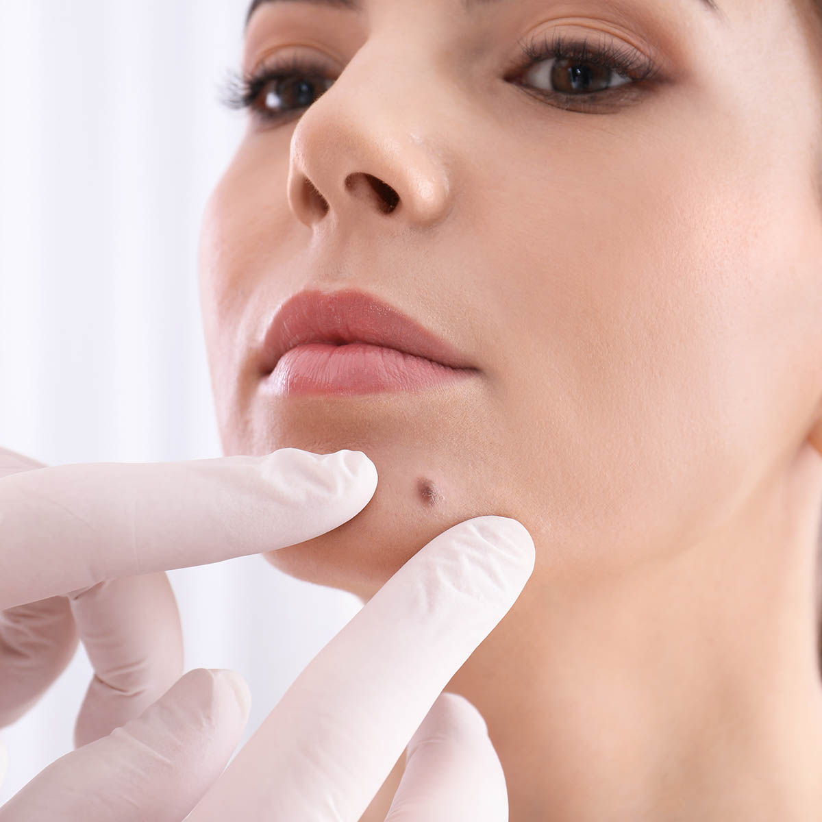 Glasgow Skin Cancer Clinic | Excision of Benign Lesions Such As Moles ...