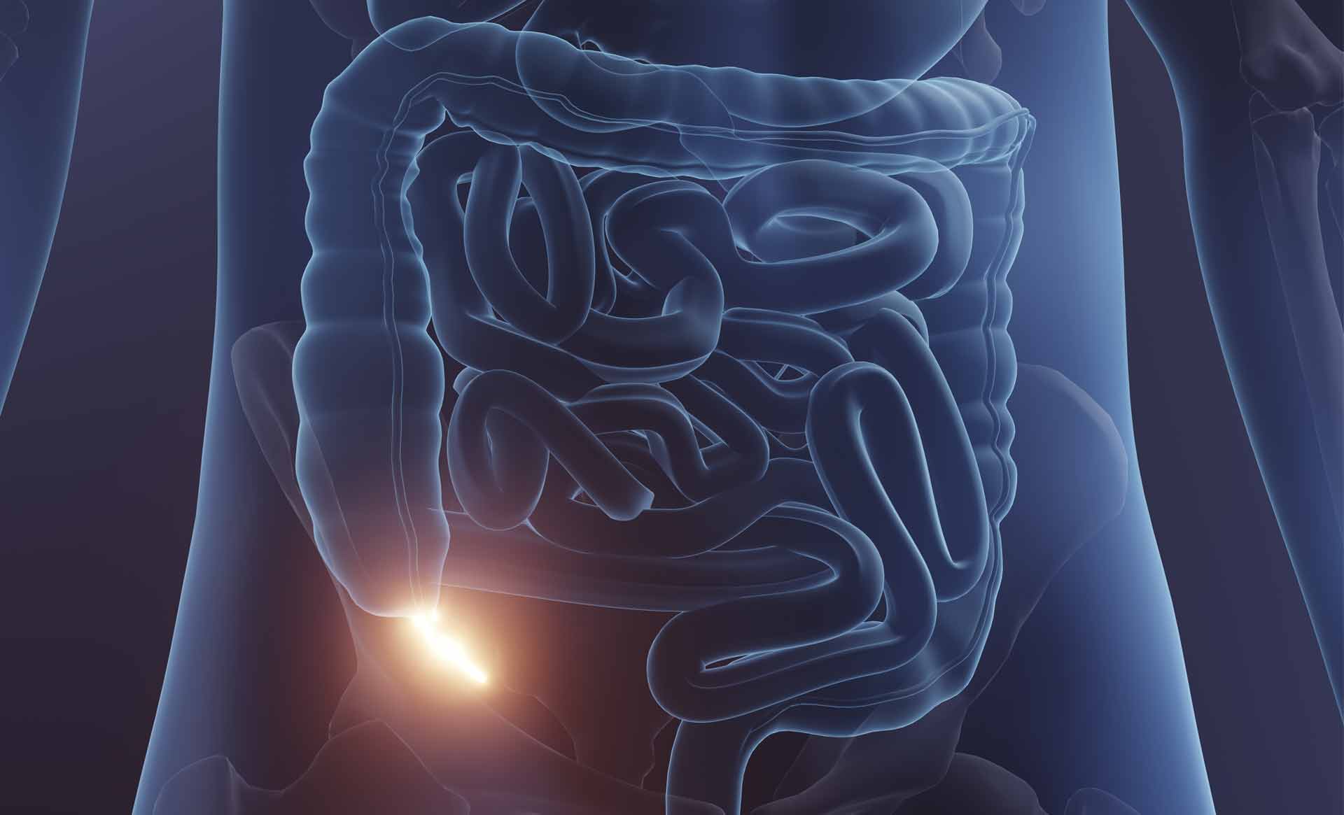 Tudo sobre Apendicite aguda para você arrasar nas provas