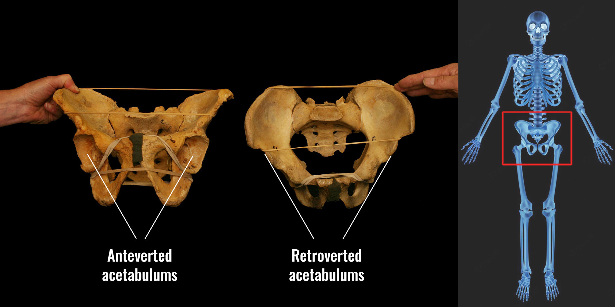 Do your genes determine your sport and your back pain?