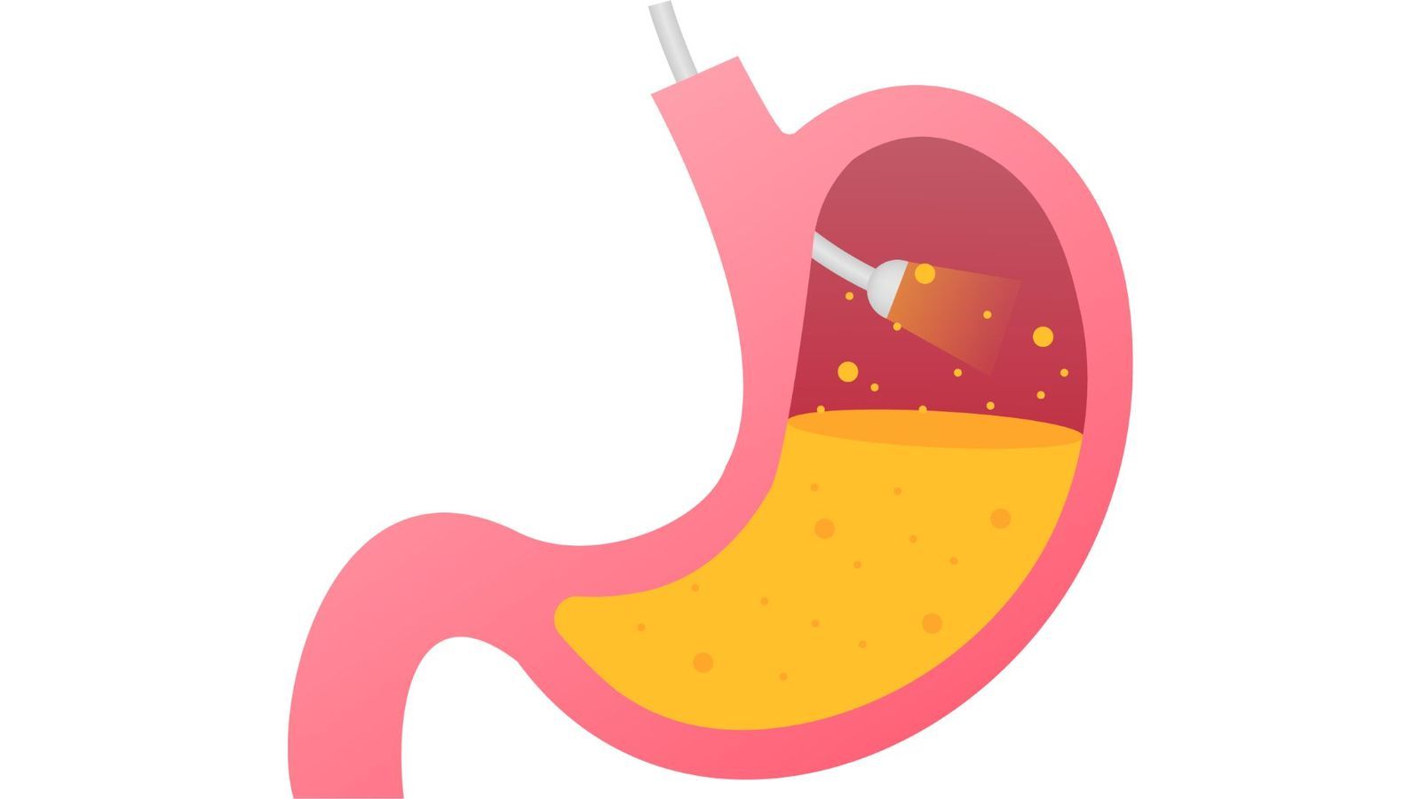 Fibroscopie gastrique - Fiche Information Patient - HoopCare