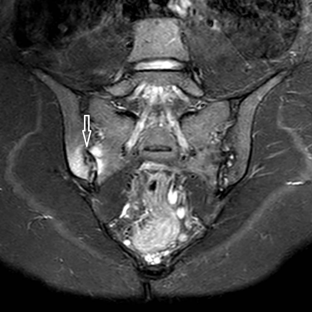 radiologiehoch3 Iliosakralgelenke