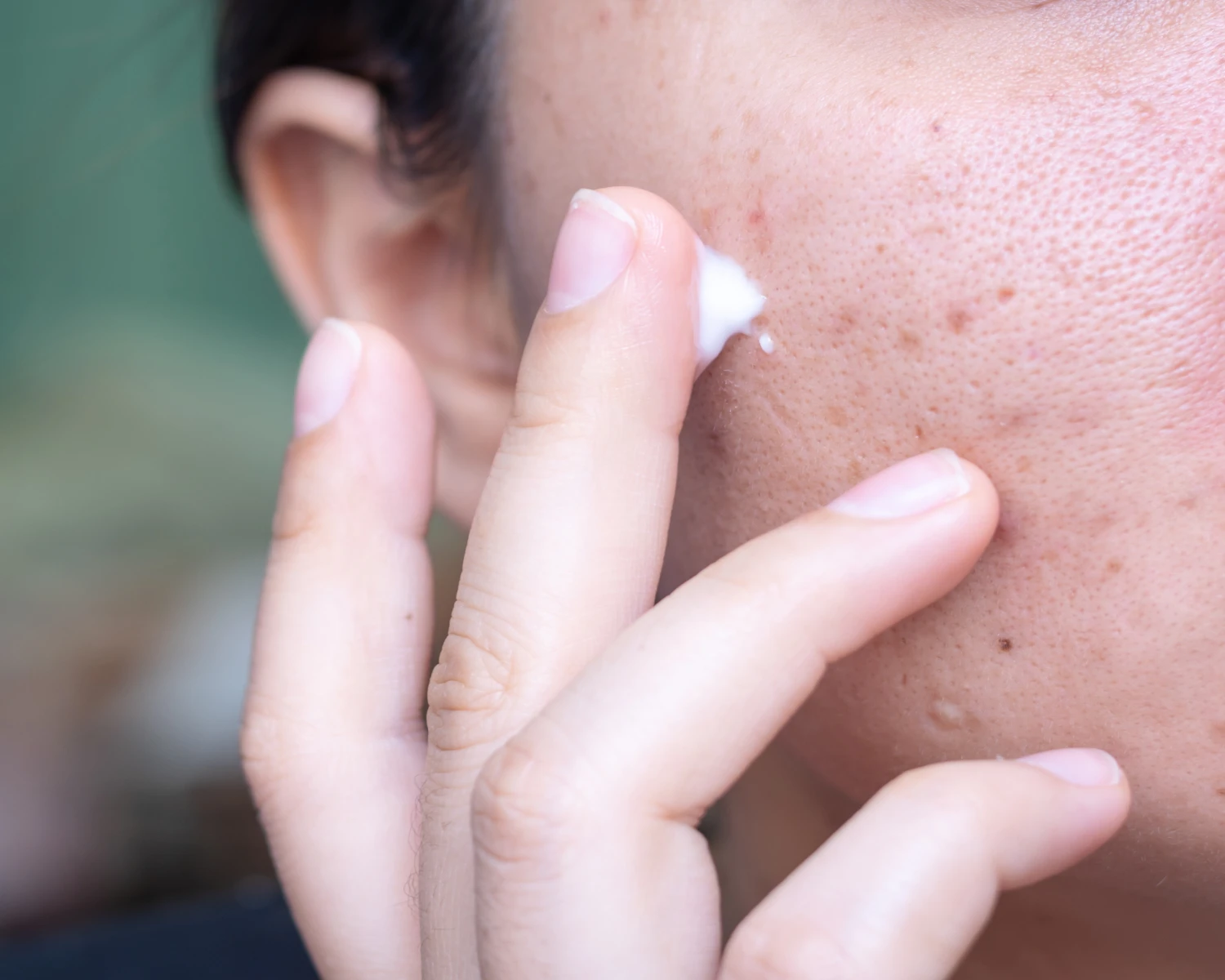 Pure Source Your Trusted Acne Product Manufacturer and Salicylic Acid ...