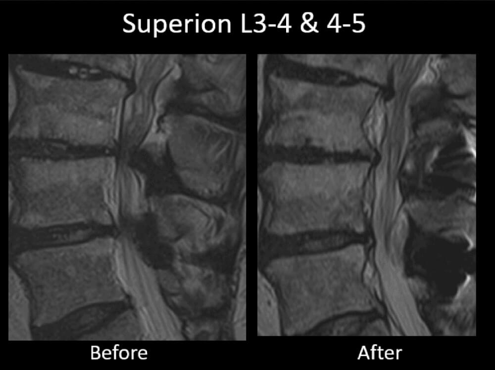 Vertiflex Superion Procedure in Austin, TX | GAPC