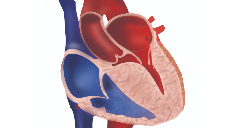 Genetic Heart Disease | Progenics