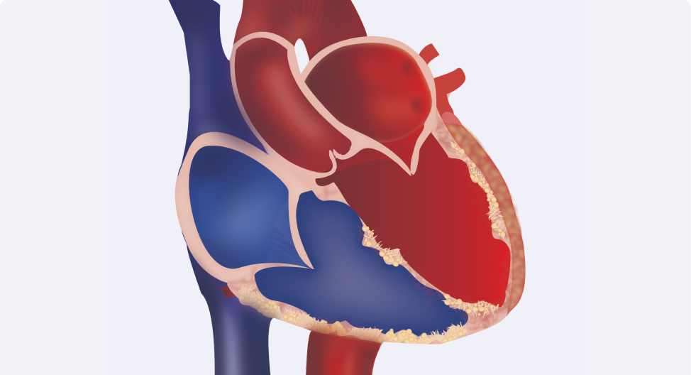 Genetic Heart Disease | Progenics