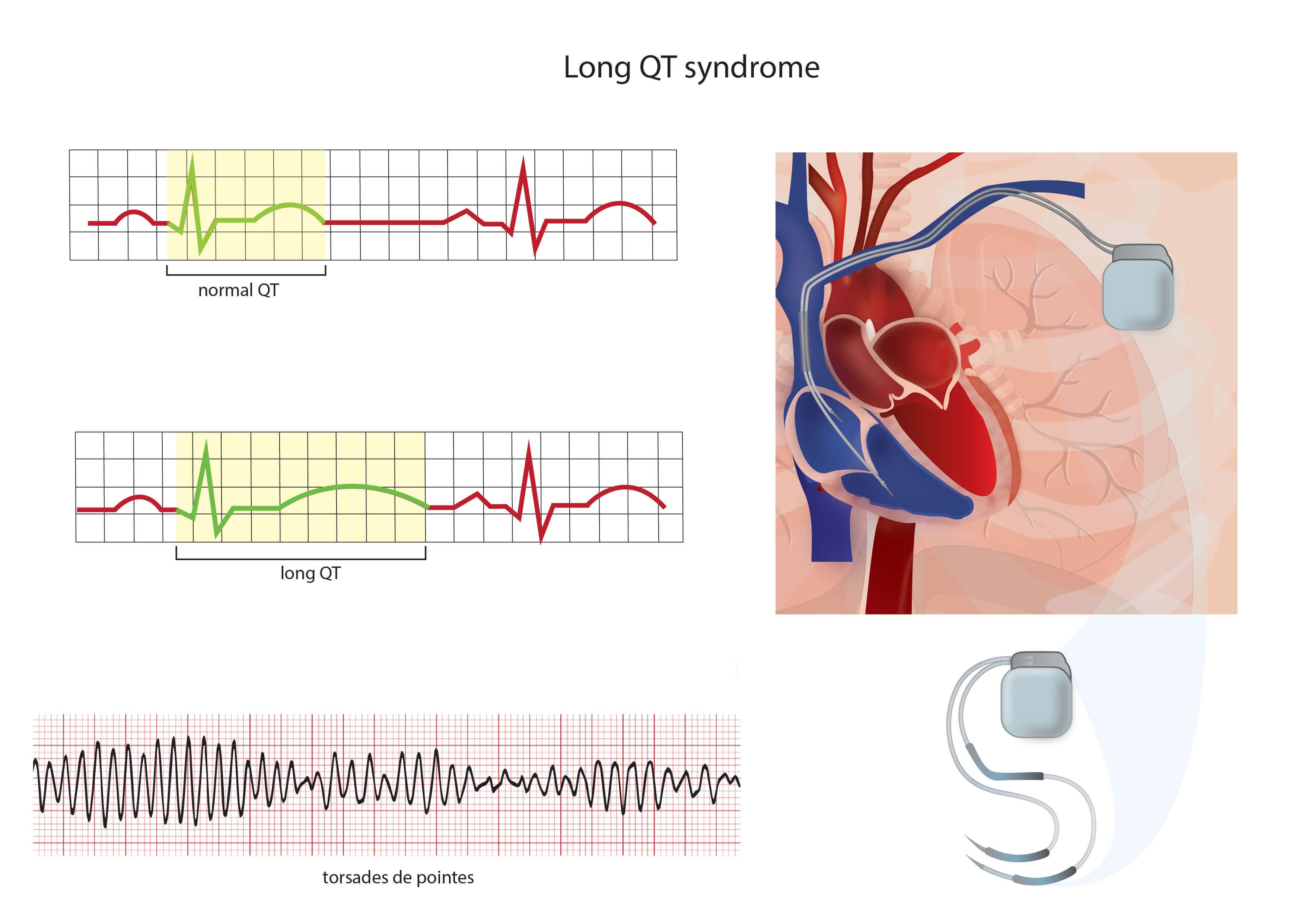 Long QT Syndrome | Progenics