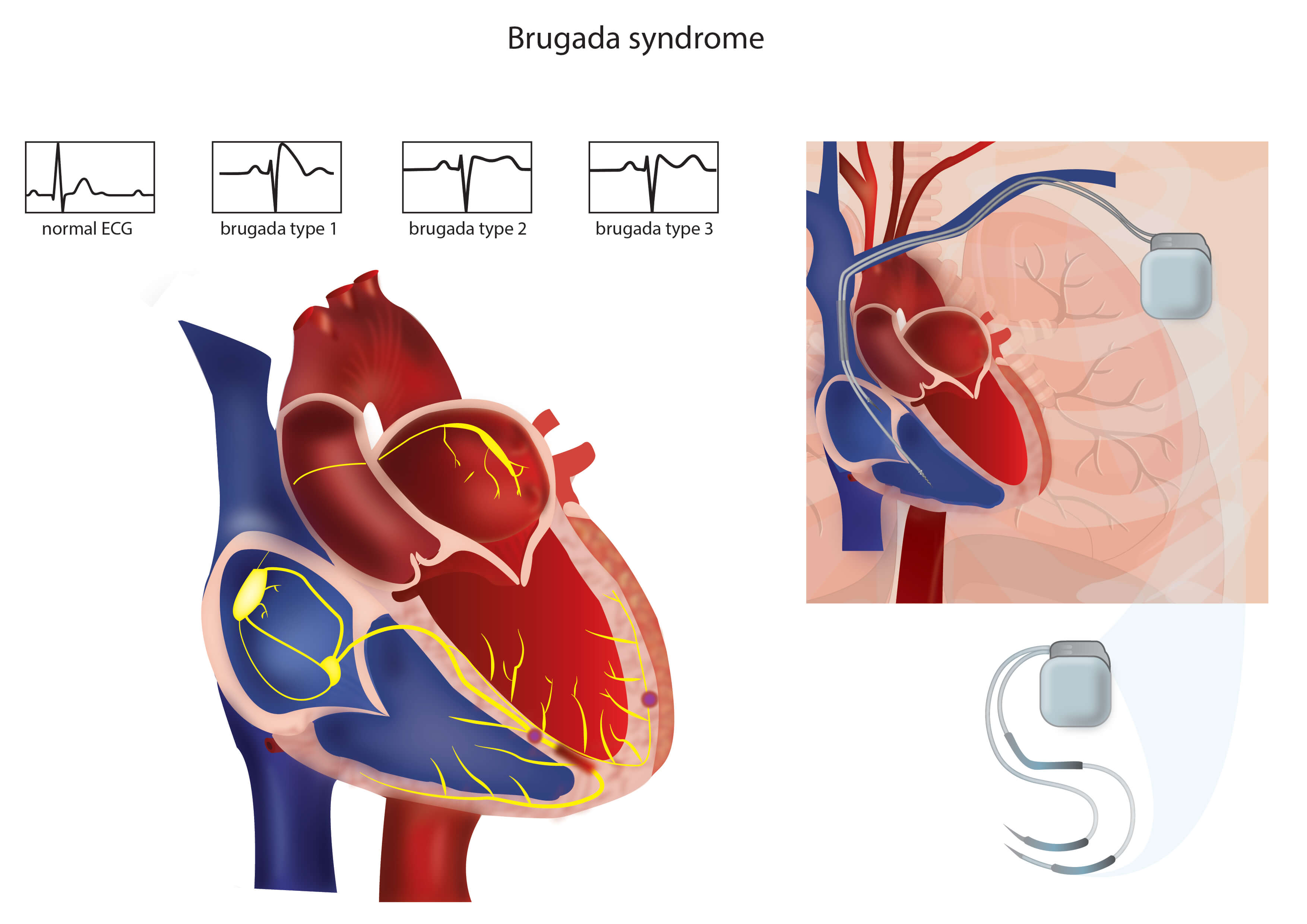 Brugada syndrome | Progenics