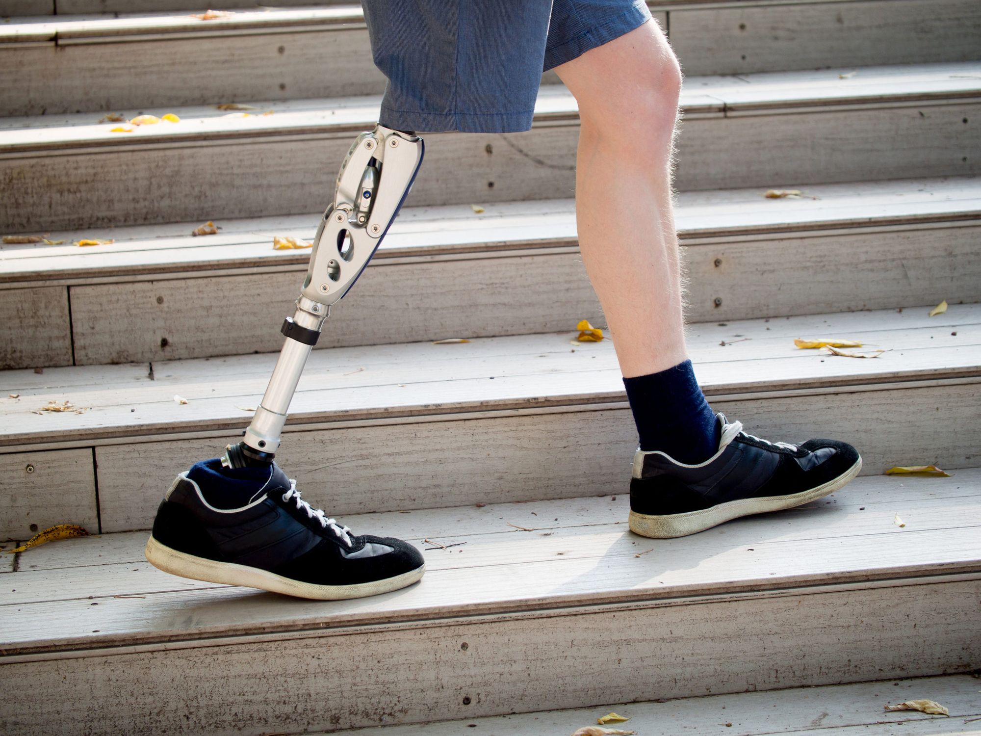 What is a Self-Suspended Prosthesis? | HOPE KC