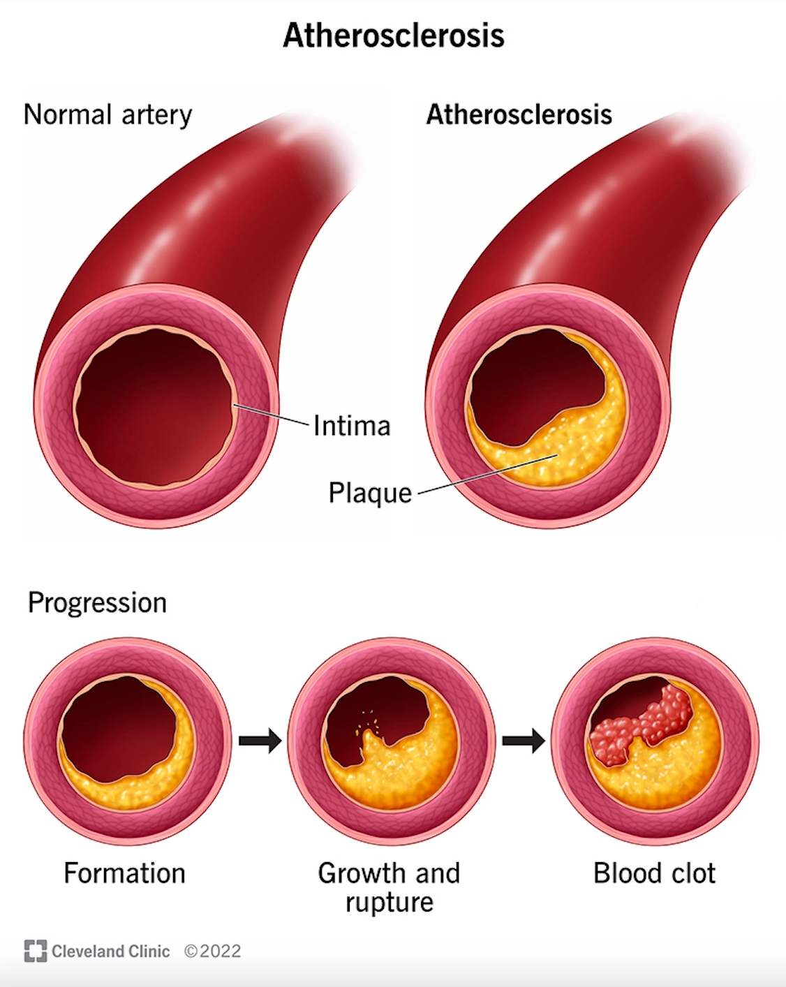 Macromo | Coronary Artery Disease