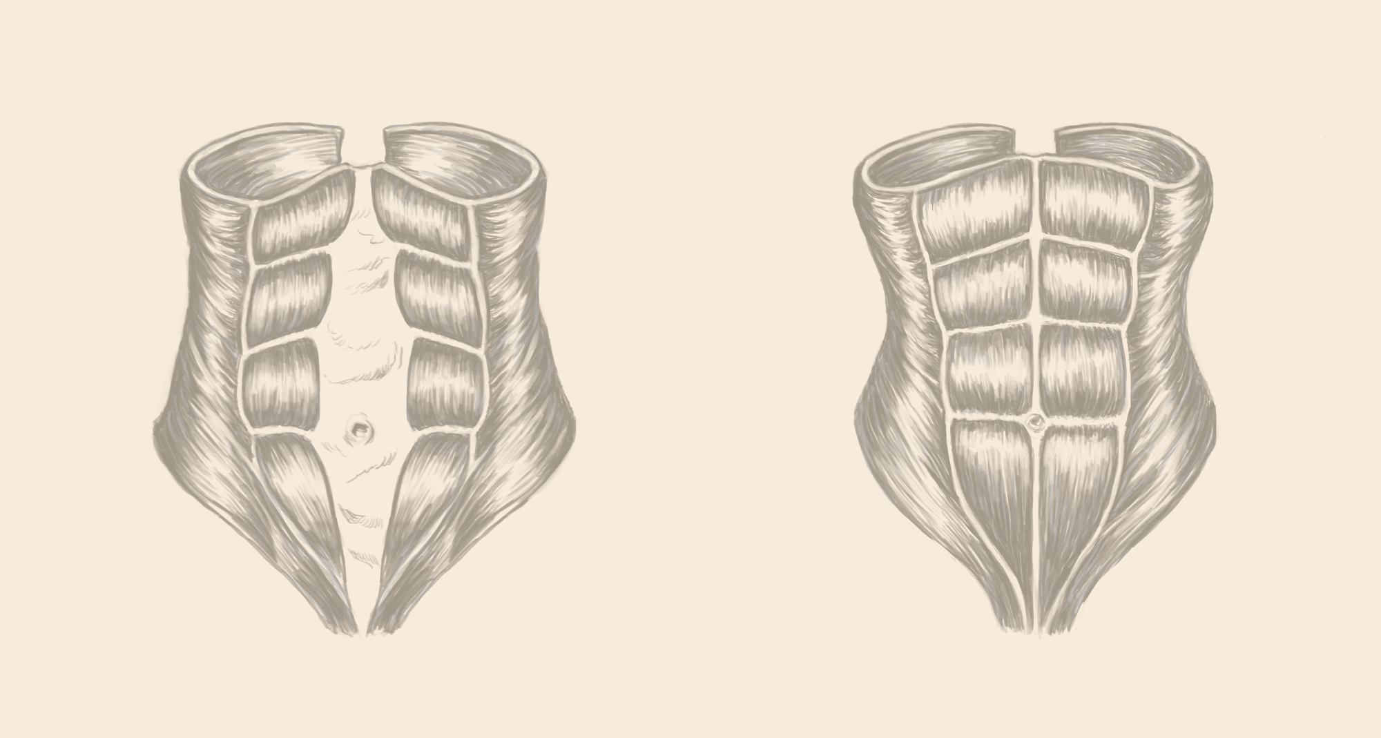 Diastasis Recti