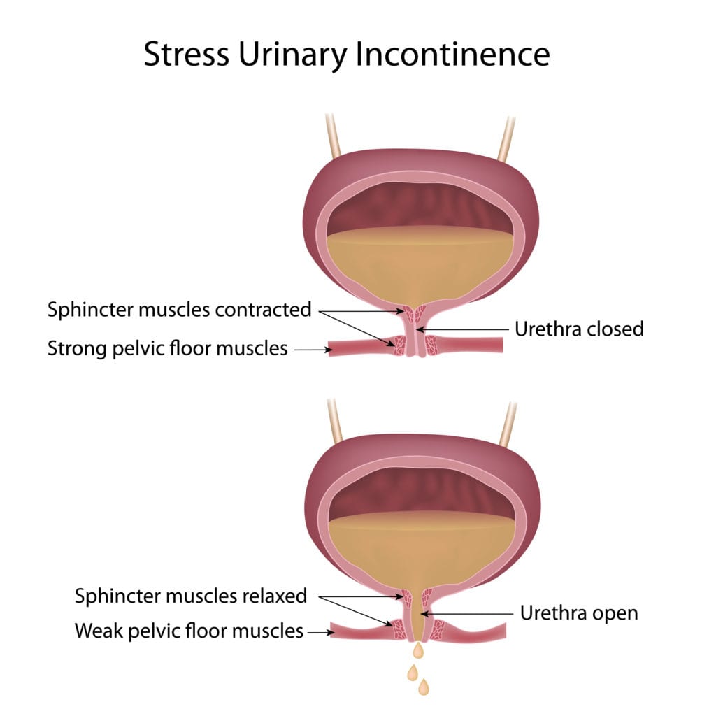 Stress Urinary Incontinence And Diastasis Recti Every Mother Stress Urinary Incontinence And Diastasis Recti Every Mother