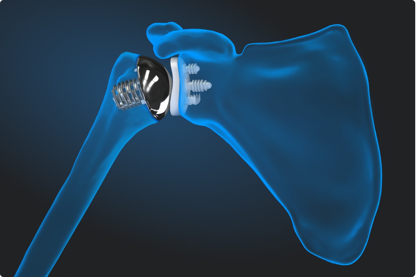 Arthrex Arthroplasty