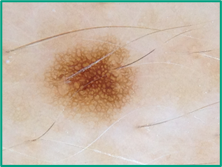 Dermatoscopia nos nevos melanocíticos adquiridos comuns - Blog da IPEMED