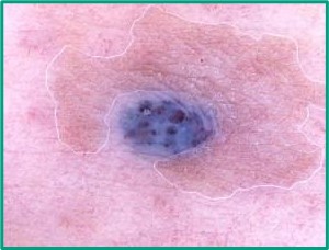 Quais são as características da dermatoscopia dos tumores benignos ...