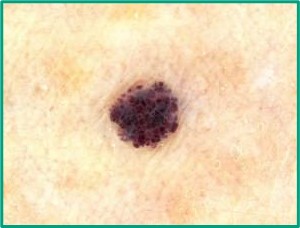 Quais são as características da dermatoscopia dos tumores benignos ...