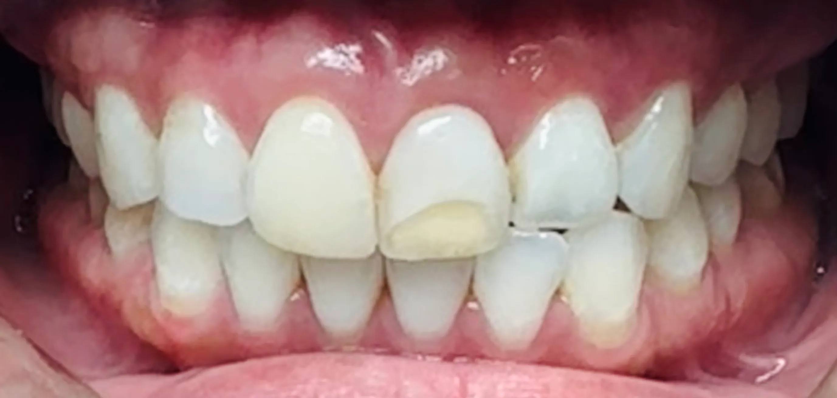 Before & After | Healthy Smiles Dentistry