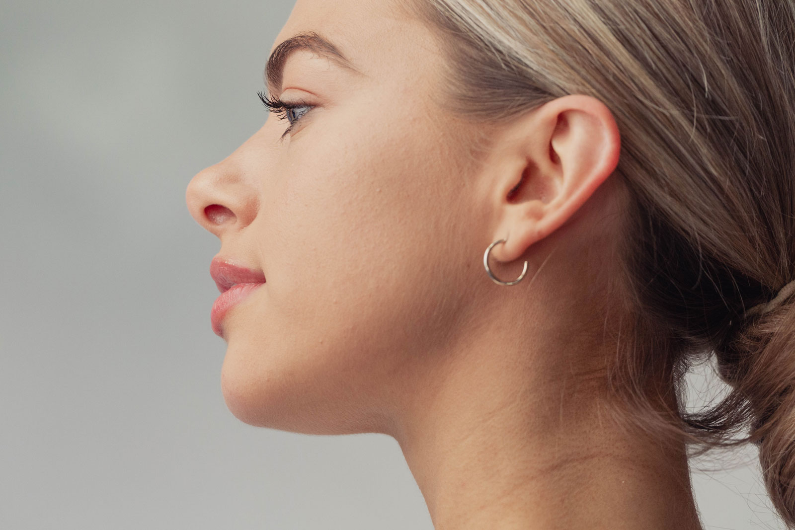 FRAX Laser Resurfacing in El Dorado Hills, Sacramento & Rocklin ...